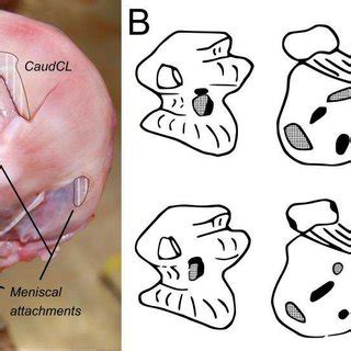 A Proximal View Of The Proximal Right Tibia And Fibula Showing Distal Download Scientific