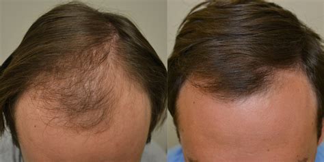 Propecia Before And After Photos Dr Rogers New Orleans