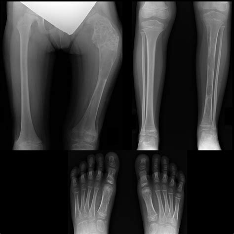 Fibrous Dysplasia Pediatric Radiology Reference Article Pediatric Imaging Pedsimaging