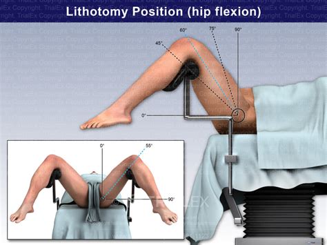 Lithotomy Position