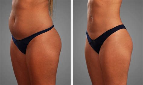 Swelling After Liposuction Causes How Long It Lasts And How To Manage It