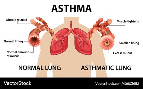 Bronchioles Asthma