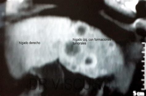 Que Vi Hoy Cáncer De Hígado