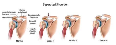 Shoulder Separation Symptoms Causes Treatment By Shoulder Separation