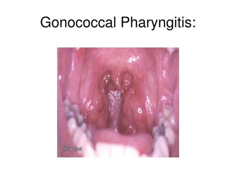 Ppt Otitis And Pharyngitis In Peds Chp 121 Tintinalli Powerpoint Presentation Id 293231