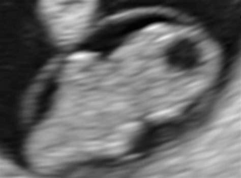 4 Week Ultrasound Pictures
