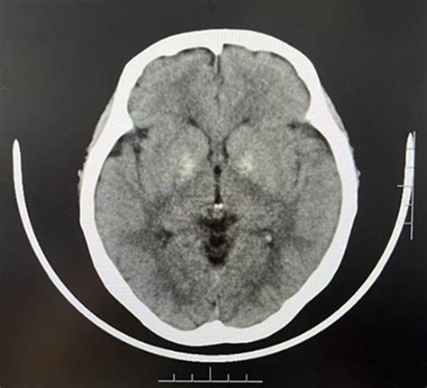 Pseudohypoparathyroidism Type Ib Subclinical Hypothyroidism Dmso