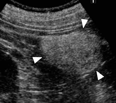 Figure 1 From Laparoscopic Resection Of A Retroperitoneal Liposarcoma