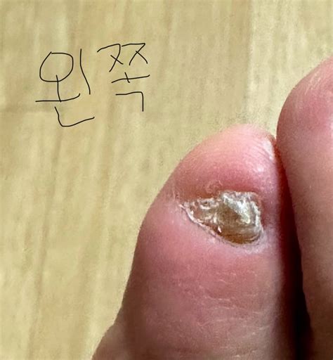 새끼 발톱이 아프고 이상하게 자라요 지식in