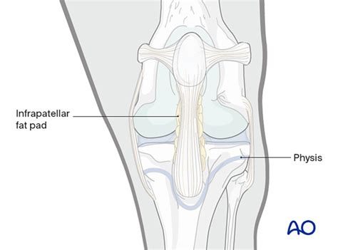 Cranial Approach To The Proximal Tibia