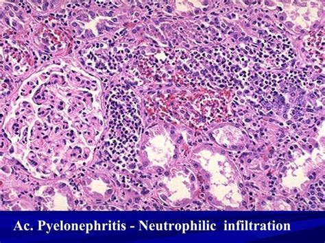 Pyelonephritis Csbrp Ppt