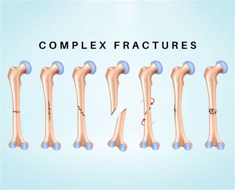 Complex Fractures