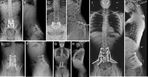 Spinal Osteosarcoma In The Paediatric Age Group Case Series And Literature Review Revista
