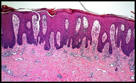 Skin Patterns Of Inflammatory Skin Disorders Flashcards Quizlet