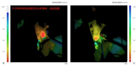 【双镜联合】基于qevo与flow 800彩色血管荧光技术的颅内多发动脉瘤夹闭术 脑医汇 神外资讯 神介资讯