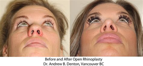 Alar Base Narrowing Nostril Narrowing Dr Denton