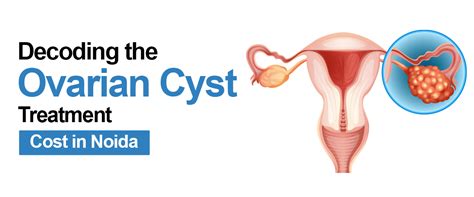 Ovarian Cyst Symptoms Causes Types Complications 52 Off