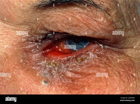 Ectropion And Chronic Conjunctivitis Close Up Of An Eye Showing Chronic Conjunctivitis Caused