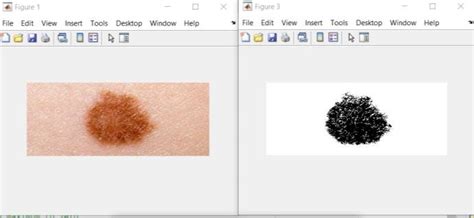 Segmented Skin Cancer Images Using Otsu Thresholding Download