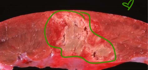 Morphology Of Necrosis Flashcards Quizlet