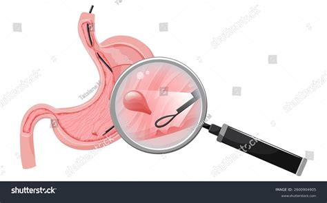 Endoscopic Polyp Removal Stomach Procedure Removing Stock Vector