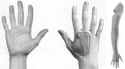 Radial Nerve Lesions • Litfl • Ffs