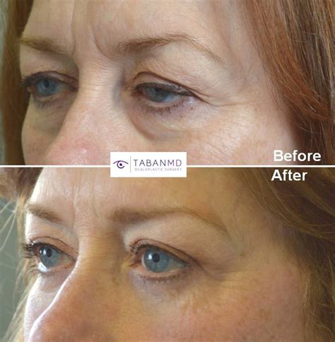 Ptosis Surgery Beverly Hills Droopy Eyelid Surgery Los Angeles
