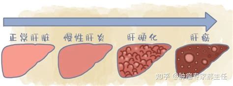 肝癌形成需要哪些过程？ 知乎