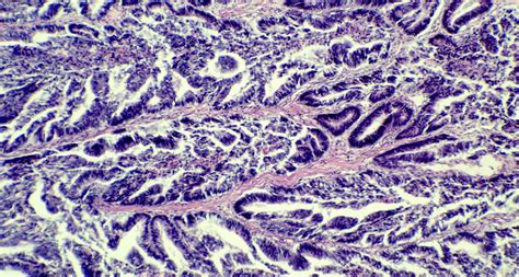 Behandlungs­reihenfolge Bei Rektumkarzinom Entscheidend Für