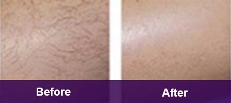 Professional 755nm Fiber Laser Hair Removal Machine Prettylasers