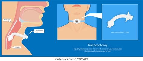 Tracheostomy Images Stock Photos Vectors Shutterstock