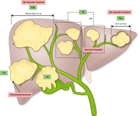 The Morphomolecular Features Of Cholangiocarcinoma In The Personalised