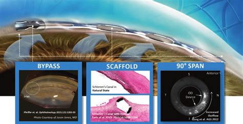 3 The Hydrus ® Microstent Delivery System Copyright Ivantis Inc Download Scientific Diagram