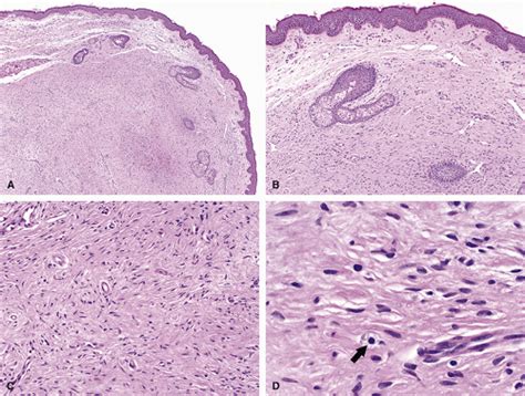 Neurofibroma Solitary Ento Key