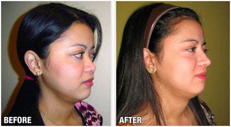 Filipino Before And After Rhinoplasty Cosmetic Surgery By Drraynald
