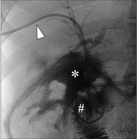 Percutaneous Trans Hepatic Cholangiography From Internalexternal Download Scientific Diagram