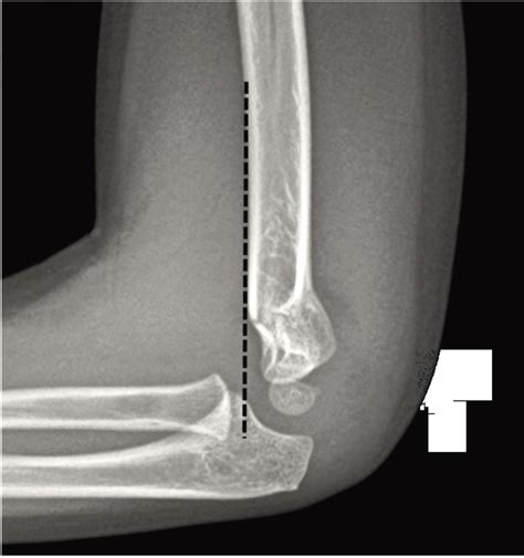 How To Screen A Paediatric Elbow X Ray For Injuries