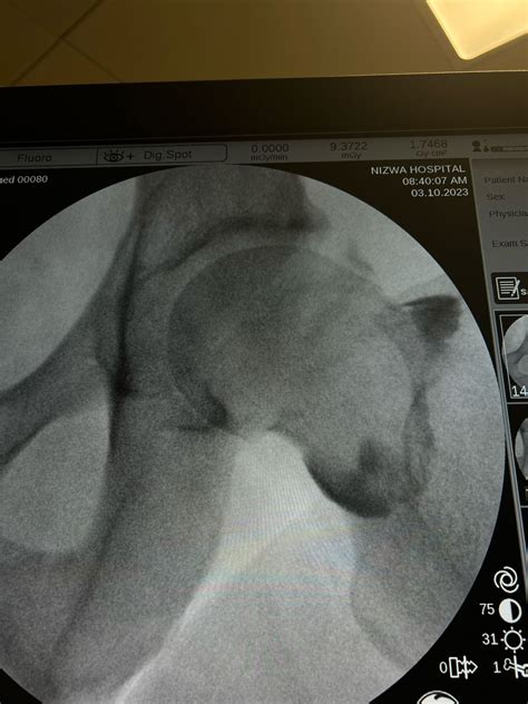 Us Guidance With Fluoroscopy Assistance For Hip Joint Injection In