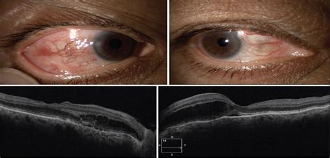 Posterior Scleritis Prognosis At Brodie Puddy Blog