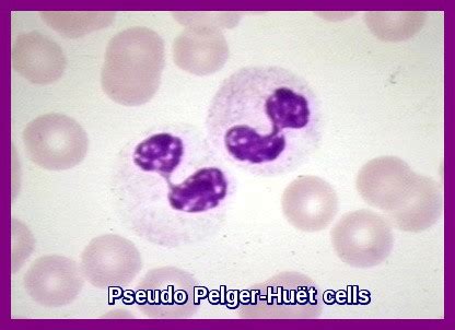 Myelodysplastic Syndromes Mds New