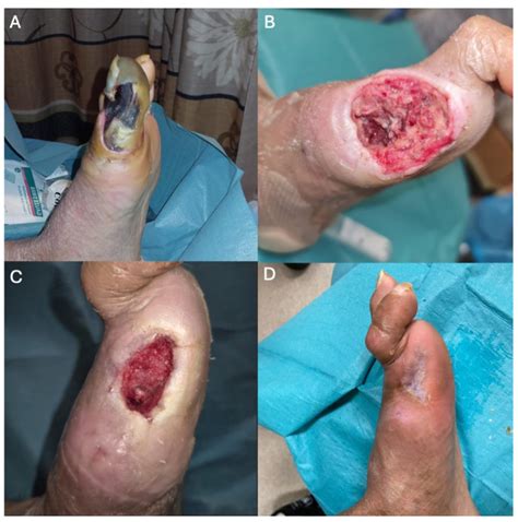 Atherectomy In The Treatment Of Peripheral Arterial Disease—a Case Series To Demonstrate