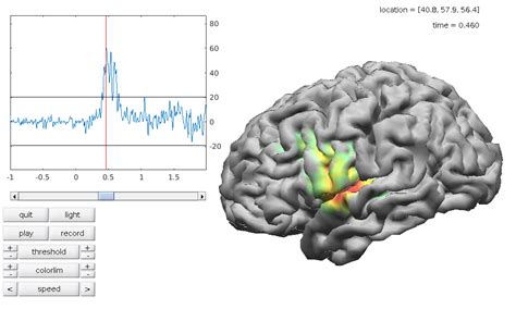 Source Reconstruction Of Event Related Fields Using Minimum Norm Estimation Fieldtrip Toolbox