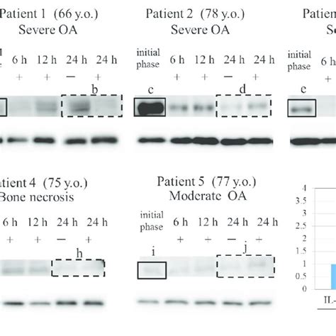 Effects Of Il β On Runx2 Expression In Osteoarthritic Chondrocytes From