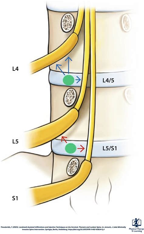 Physical 📌the Lumbar Nerve Roots Are Only Tangentially Affected By