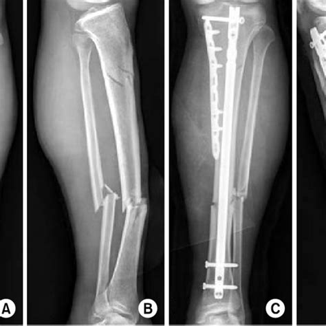A B Preoperative Radiographs Of A 51 Year Old Man Show A Tibia Download Scientific Diagram
