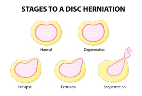 Bulging Disc Vs Herniated Disc What S The Difference Can