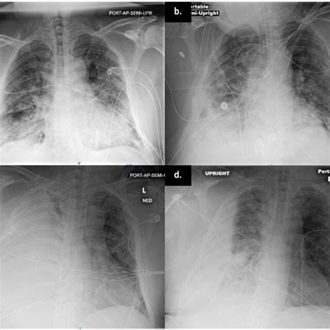 A D A The Patients Cxr On Admission D1 B Cxr On D10 C Cxr