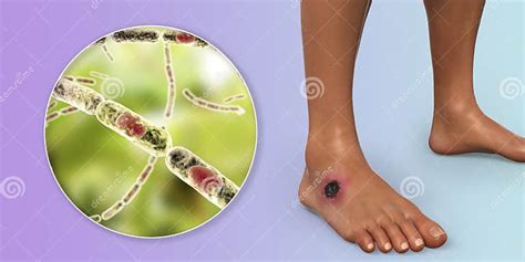 Cutaneous Anthrax The Most Common Form Of Anthrax Stock Illustration Illustration Of Human