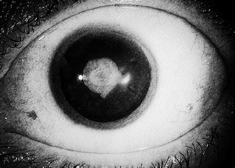 Congenital Cataracts