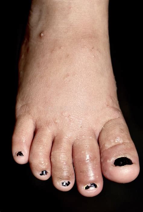 Scabies Infestation With Secondary Bacterial Infection Or Pustules In